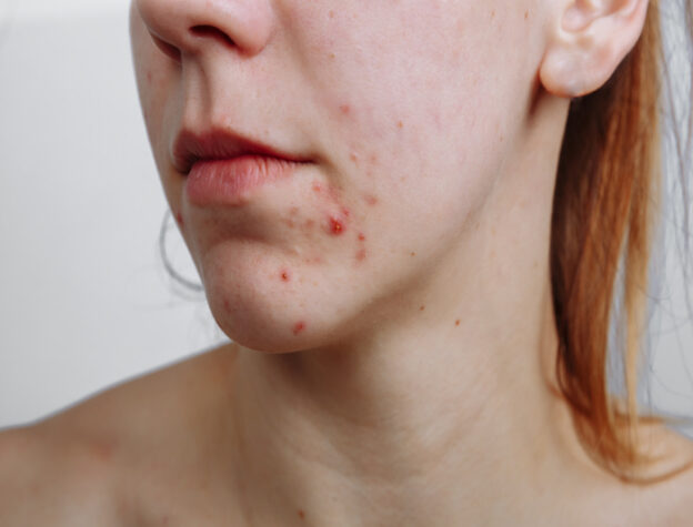 Does Anorexia Cause Acne? - Eating Disorder Hope
